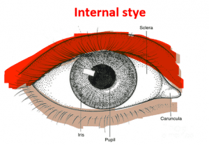 Eye Infections - Conjunctivitis Causes, Symptoms and Treatment