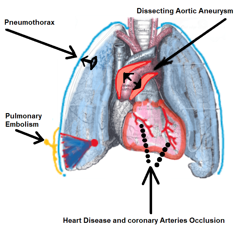 Chest Pain Causes, Symptoms and Treatment - Urgent Care in Ypsilanti