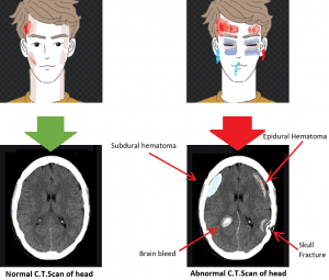 Traumatic Brain Injury - Medical Care One