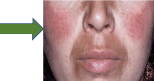 Common Disorders of Skin Pigmentation – Medical Care 1