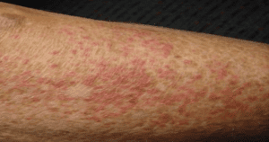 Skin Rashes Causes, Symptoms and Treatment - Medical Care 1 Ypsilanti